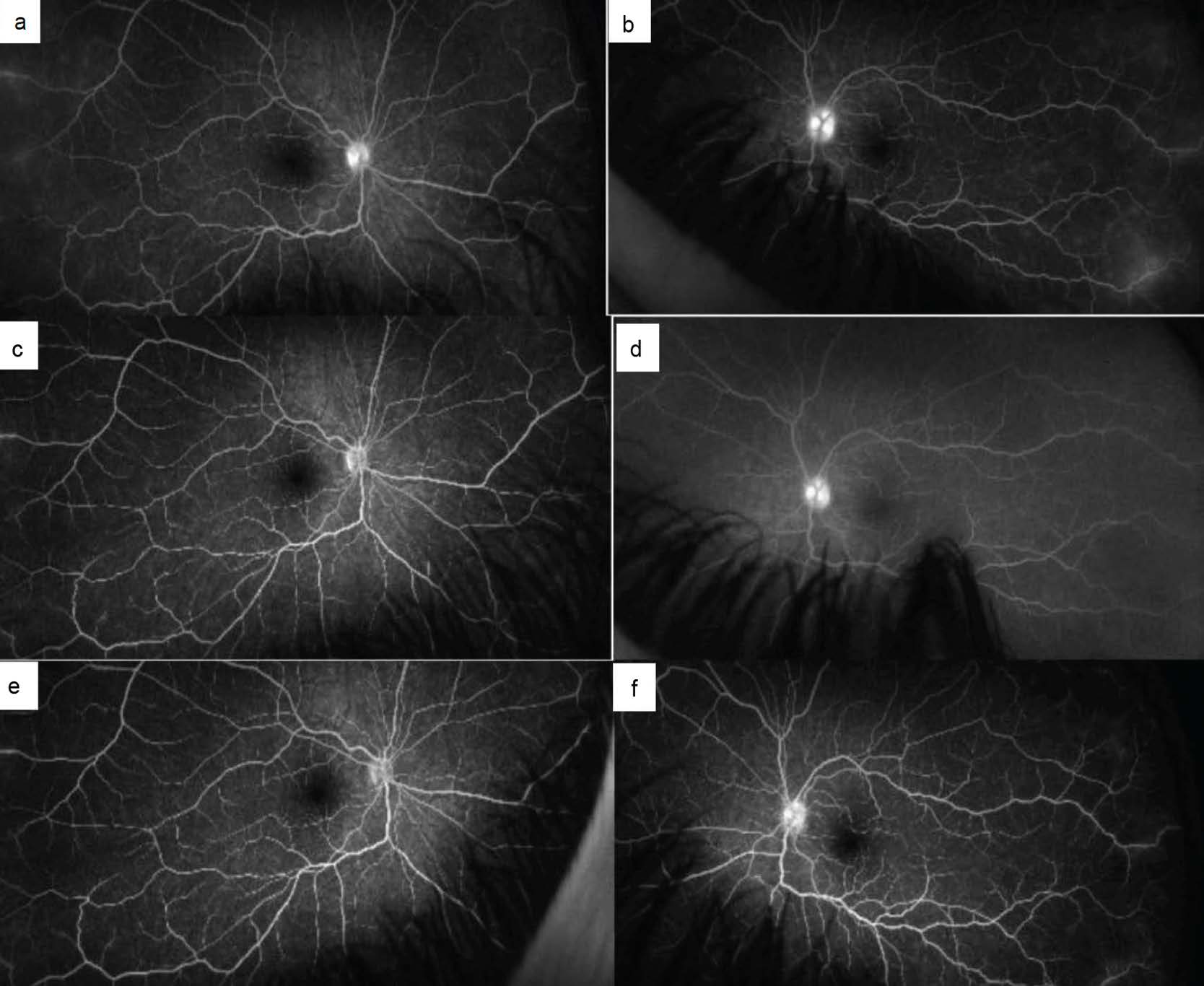 HLA-B27 positive juvenile idiopathic arthritis associated uveitis ...