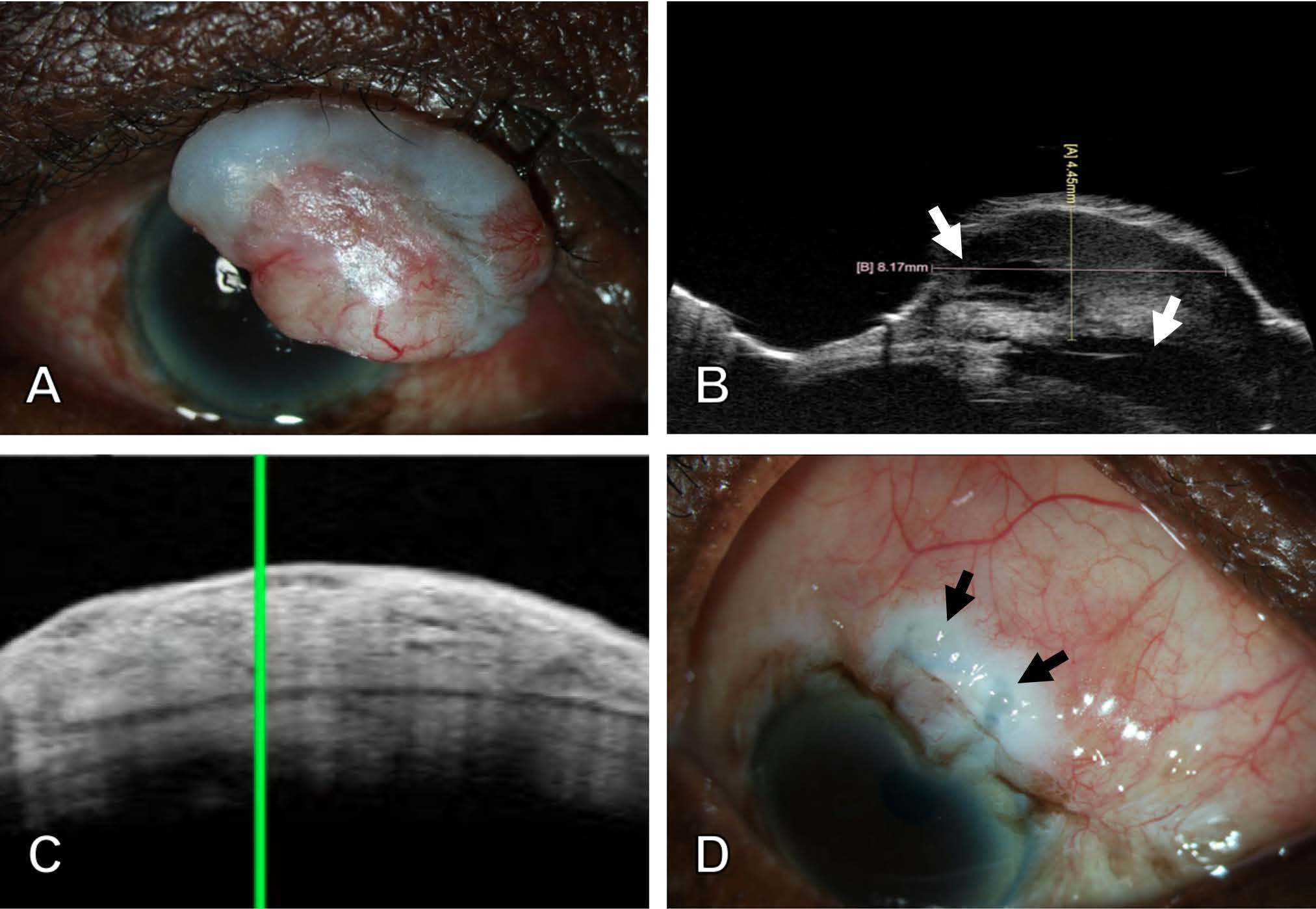 Dissecting Trabeculectomy Filtering Bleb Masquerading as Ocular Surface ...