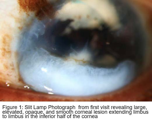 Corneal Keloid | Duke Department Of Ophthalmology