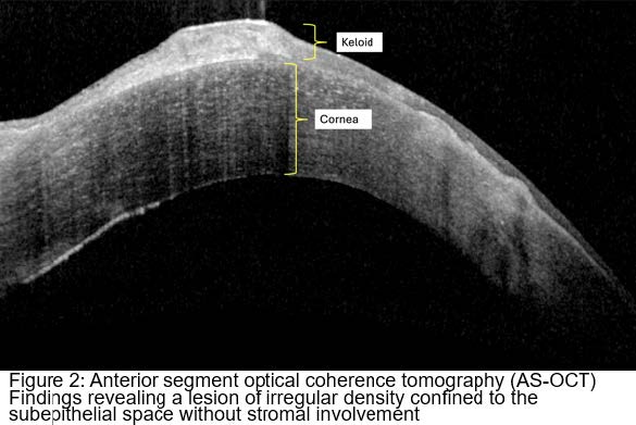 Corneal Keloid | Duke Department Of Ophthalmology