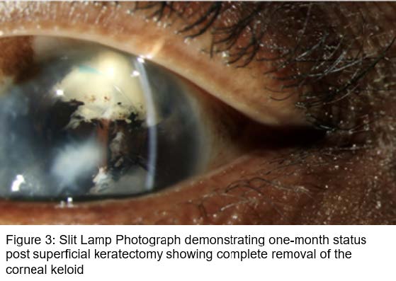 Corneal Keloid | Duke Department Of Ophthalmology
