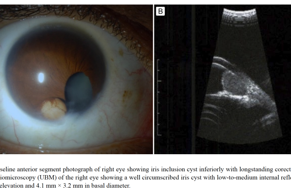 (EXAMPLE) Case report: Spontaneous rupture of secondary iris inclusion ...