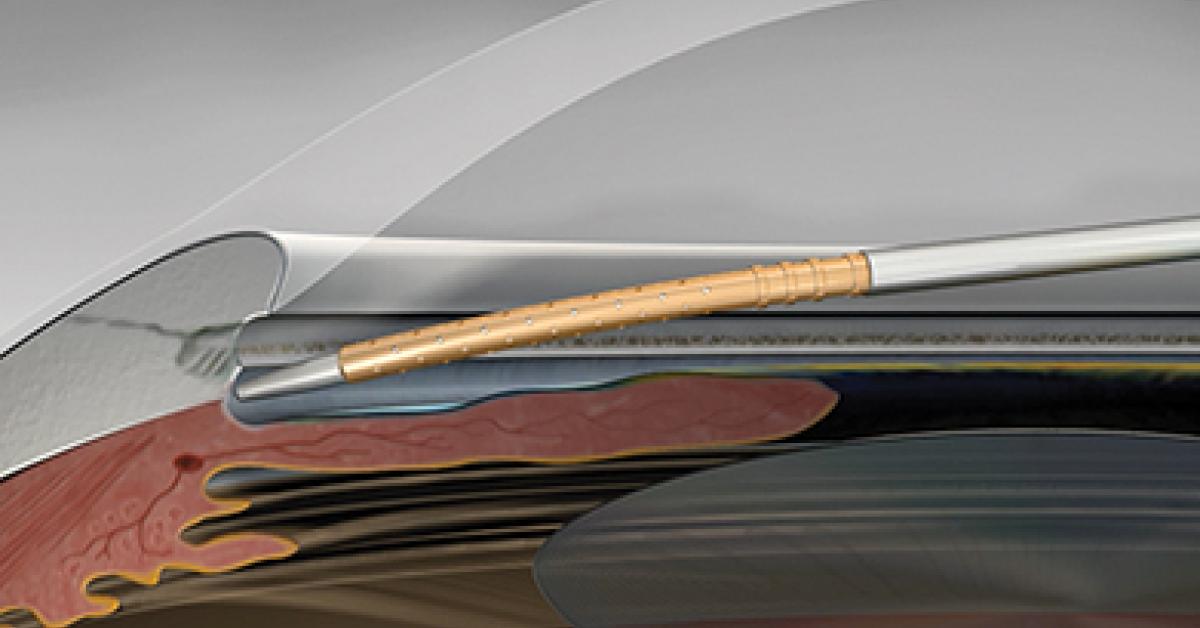 New FDA-Approved Glaucoma Stent Offered at Duke Eye Center | Duke ...